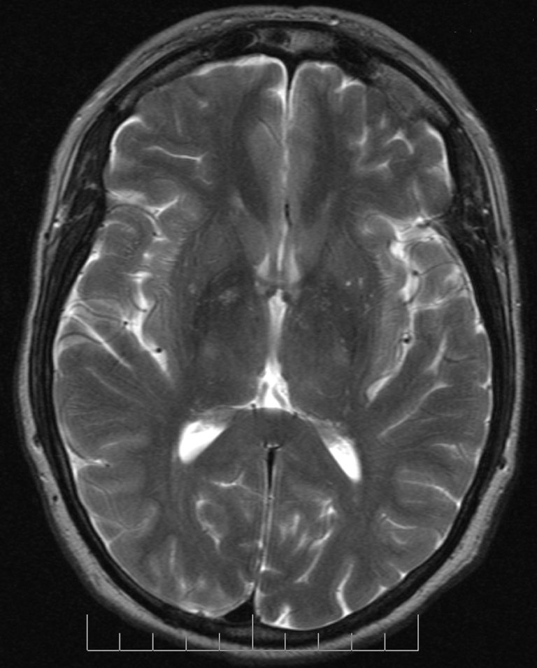 MRI_T2_Brain_axial_image | Medical Science Navigator MRI_T2_Brain_axial_image | Medical Science Navigator